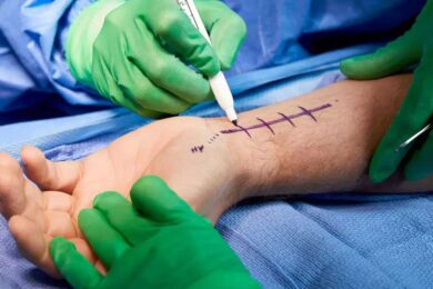 Hand Surgeries - Dr Issam Mardini