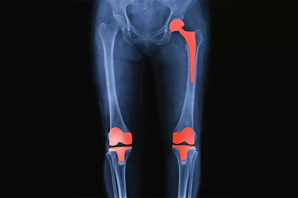 Joint replacements of hip knees and shoulders replacement and revision ...
